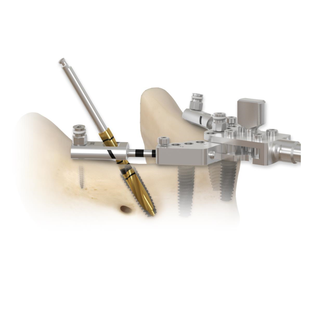 TRUSA DENTURE 4U KIT ALL ON X OD4UK