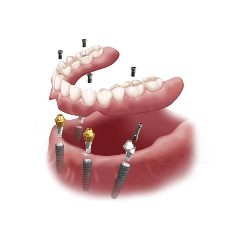 TRUSA DENTURE 4U KIT ALL ON X OD4UK